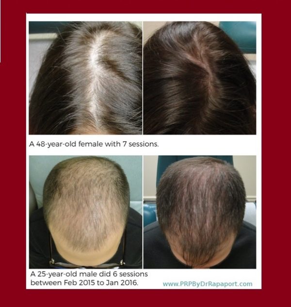 Hair Restoration | Dermatology & Laser Centre of Los Angeles