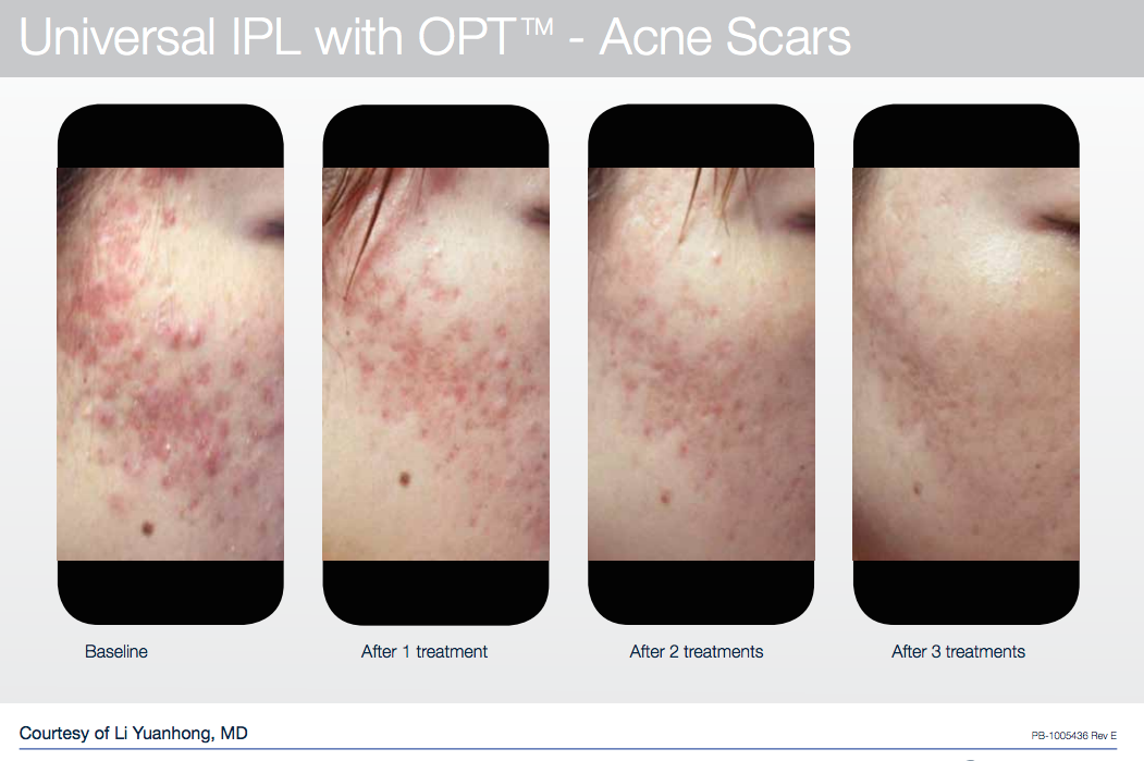 PhotoFacial | Dermatology and Laser Centre of Los Angeles