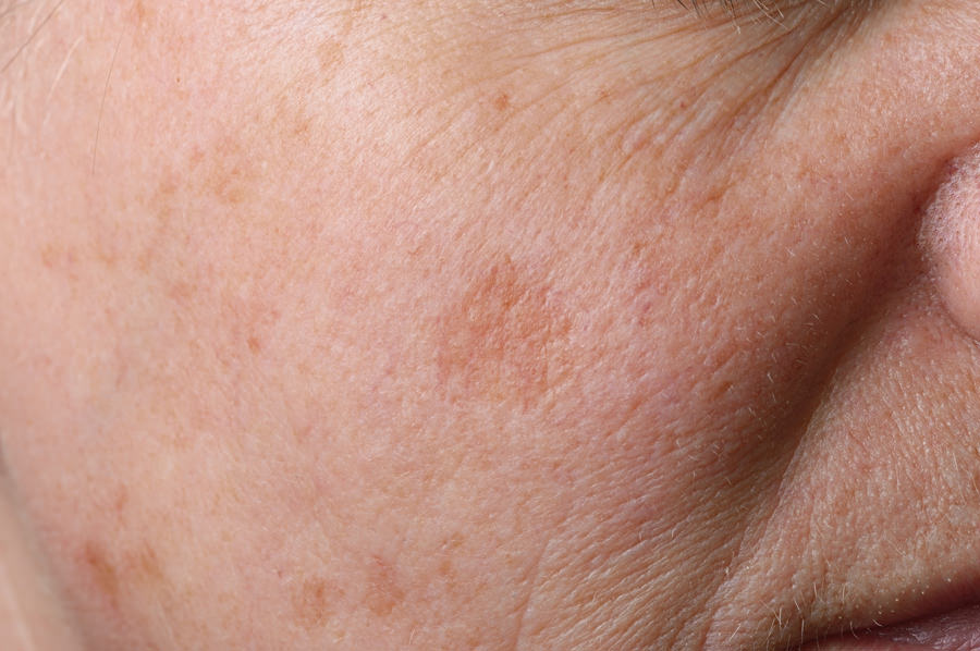 Age Spots | Dermatology and Laser Centre of Los Angeles