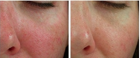 Skin Rejuvenation | Dermatology and Laser Centre of LA